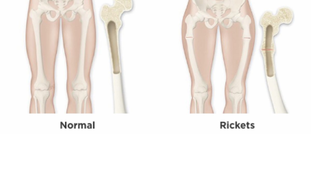 Rickets Disease Symptoms