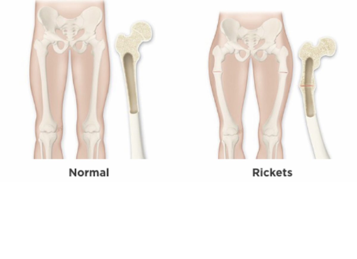 Rickets In Adults