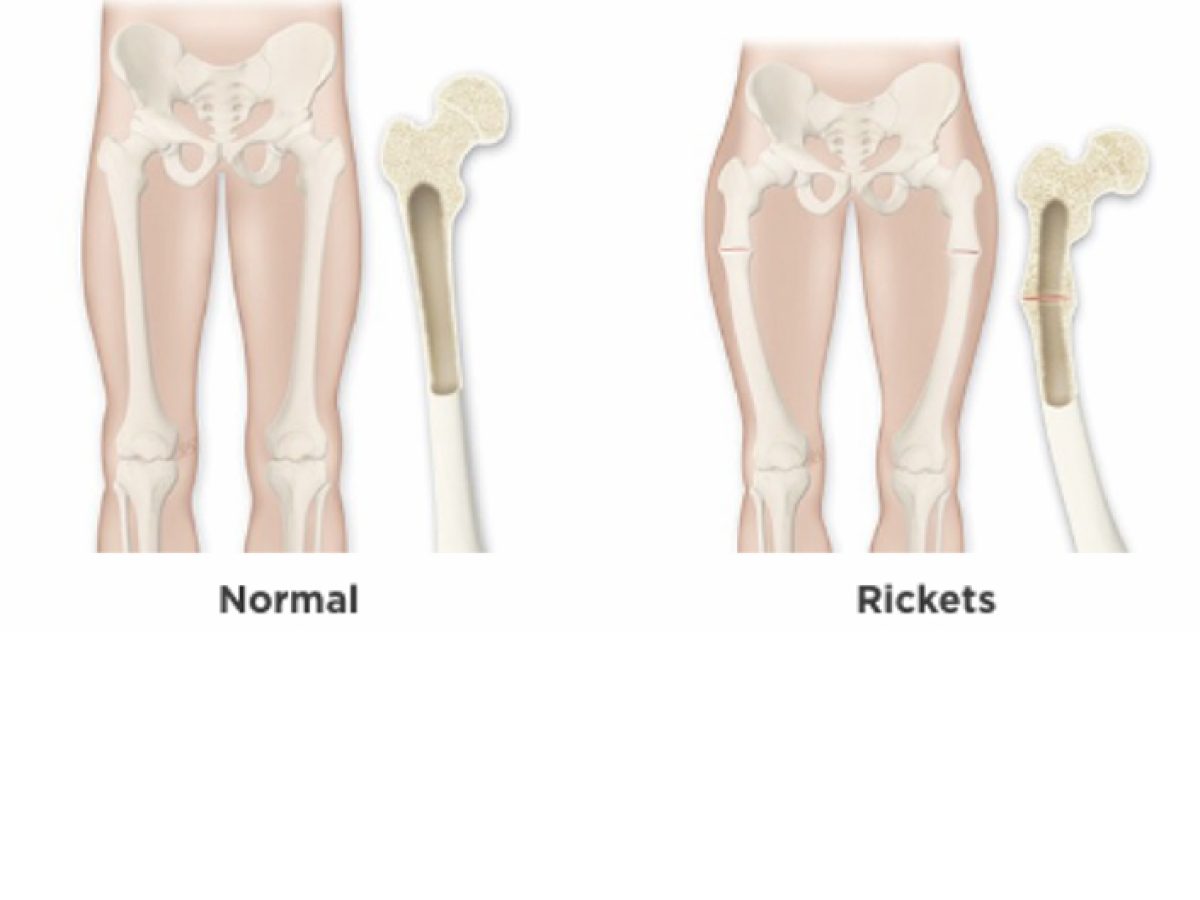 Rickets In Adults Treatment