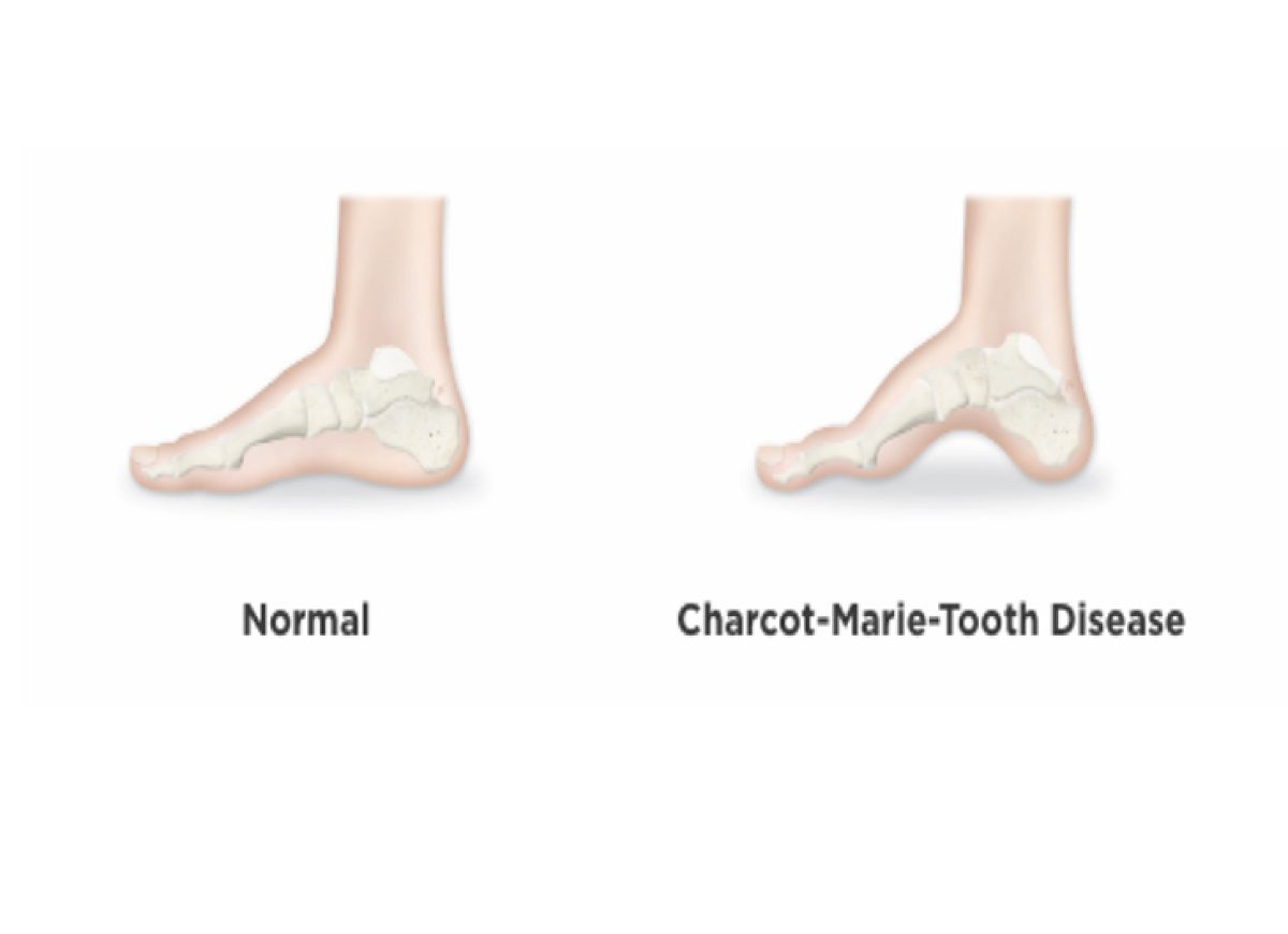 Charcot Marie Tooth Foot