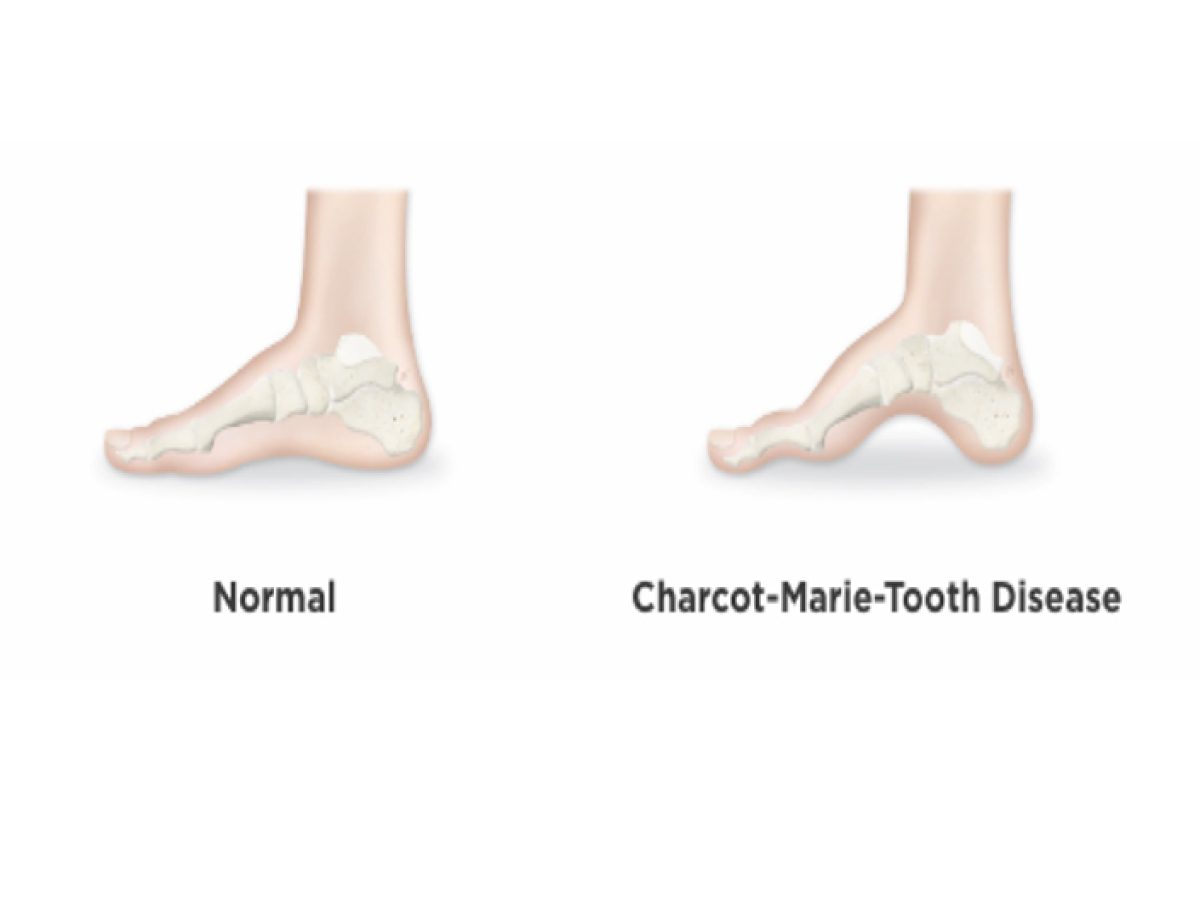 Symptoms Of Charcot Foot Disease